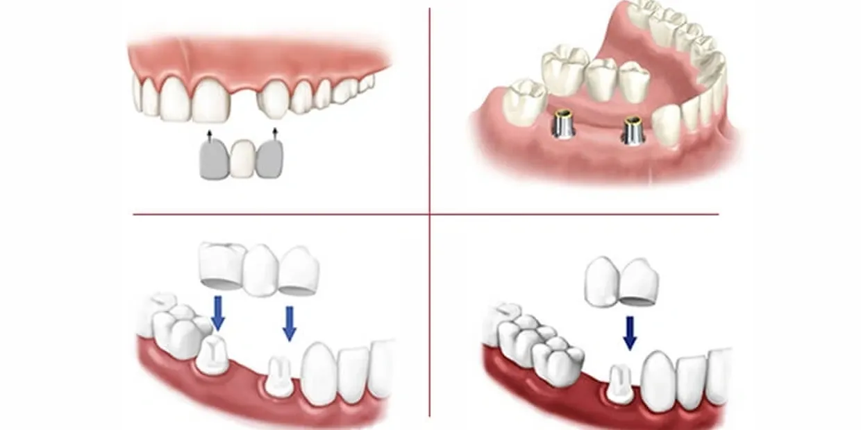 The Secret to Seamless Smiles: Dentures Bridges Demystified - Healthy ...