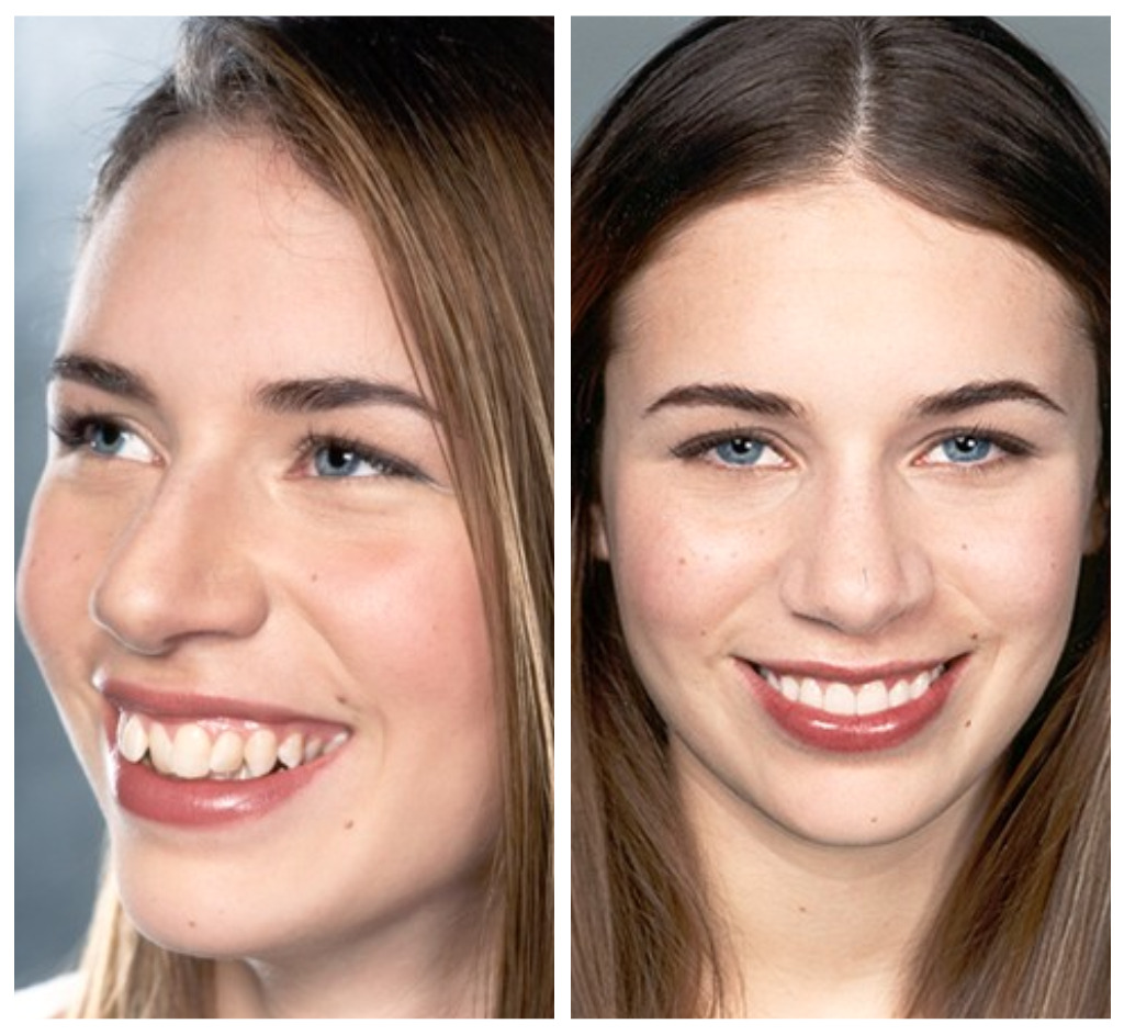 Brighten Your Day with Smile Makeovers: Expert Insights - Healthy Teeth ...